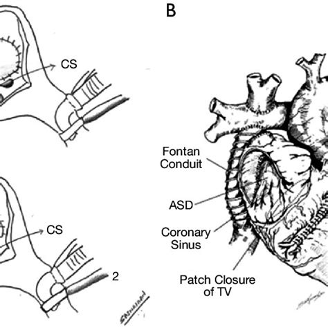 Carpentier Classification Of Ea Ea Ebsteins Anomaly Ra Right