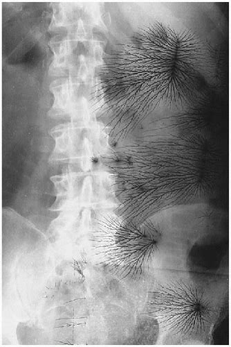 Radiographic Artifacts Radiology Key