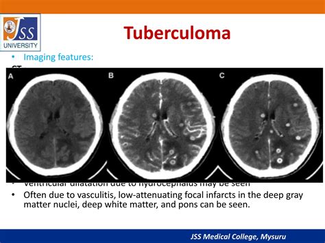Ring Enhancing Lesions¹111222222222111112 Ppt