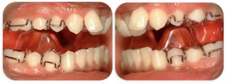 Braces For Teenagers Professor Ama Johal