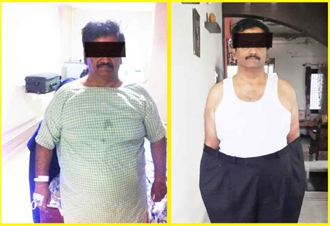 Best Laparoscopic Surgeon In Hyderabad Dr Venu Gopal Pareek