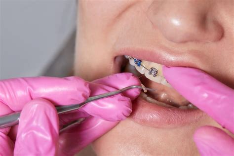 Premium Photo Dental Procedure For Installing Braces Close Upthe Procedure For The Care Of