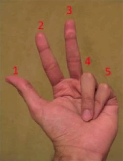 Median Nerve Palsy New