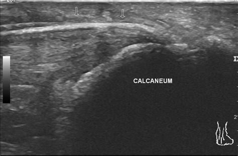 Radiopaedia Case Post Operative Achilles Tendon Ultrasound Id 80718