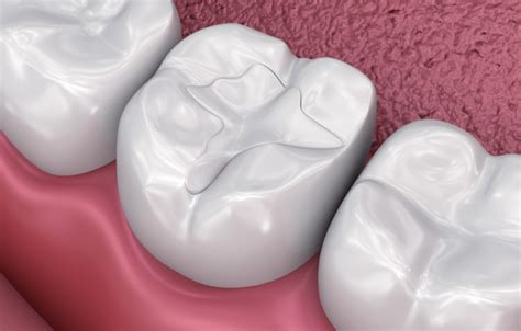 Dental Amalgam Filling Replacement