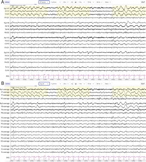 Teaching Neuroimage Temporal Intermittent Rhythmic Delta Activity