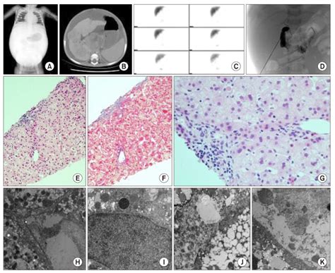 Early Diagnosis Of Abcb11 Spectrum Liver Disorders By Next Generation Sequencing Pmc