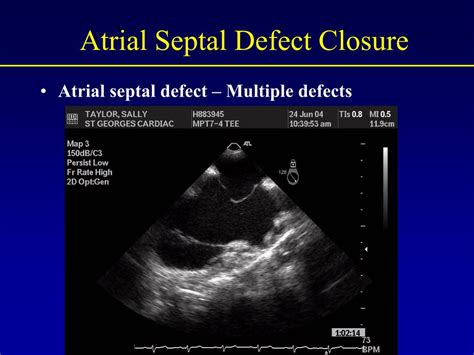 Ppt Atrial Septal Defect Closure Powerpoint Presentation Free
