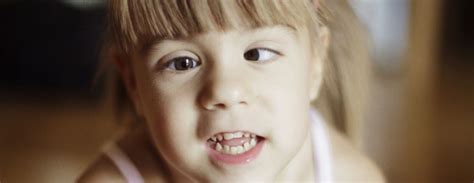 Strabismus Symptoms Causes And Treatments Cure Blindness Project