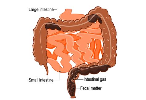 Linaclotide Safety And Efficacy In Pediatric Functional Constipation Gastroenterology Advisor