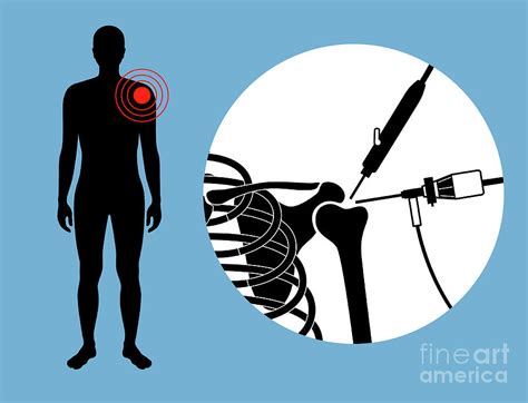 Shoulder Arthroscopy Procedure 22 By Pikovit Science Photo Library