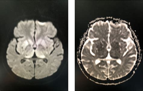 Sleep Wake Disturbance In Creutzfeldt Jakob Disease Mimicking Fatal