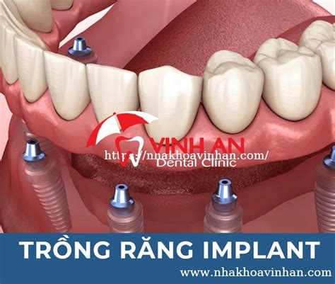Trồng răng Implant là gì Báo giá trồng răng Implant 2021 Vinhan