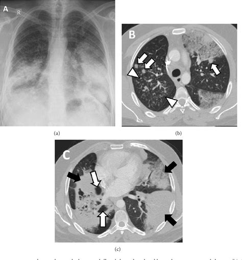 Figure 1 From Former Mucinous Bronchioloalveolar Carcinoma Revisited