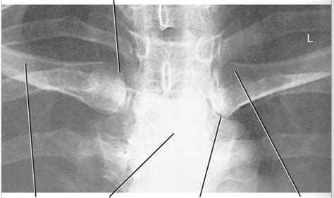 Thorax Diagram Quizlet
