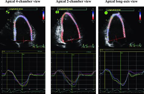 Example Of The Assessment Of Lv Longitudinal Systolic Myocardial