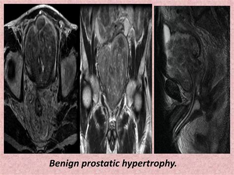 Presentation1pptx Radiological Imaging Of Prostatic Diseases Pptx