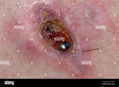 Wound In The Chest Of A Cardiac Patient Showing An Implanted Heart