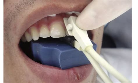Oxygen Saturation Testing Effective Tool To Evaluate Pulp Status Of Avulsed Teeth After