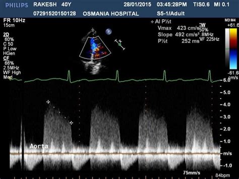 Echocardiographic Evaluation Of Aortic Stenosis