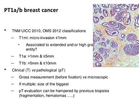 Frederique Penault Llorca Pt1ab Breast Cancer Prognostic And Pr
