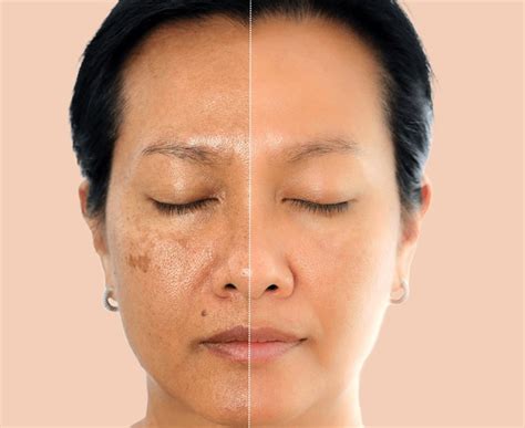 Ultimate Dark Spot Treatment Guide Effective Solutions For Flawless Skin