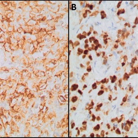 Summarizing Reported Cases Of Radiation Induced As Of The Vagina And