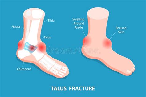 Talus Fracture Stock Illustrations 71 Talus Fracture Stock