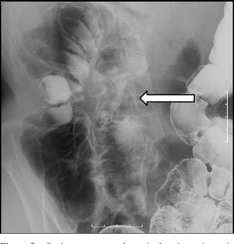 Figure 4 From A Case Of Concomitant Small Bowel Gist And Colorectal