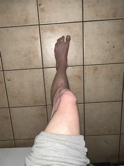 Knee Valgus Radvancedposture