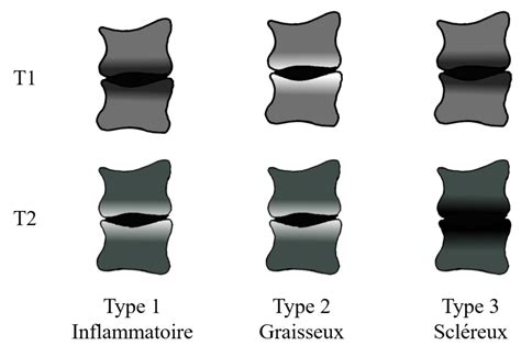 Classification Modic Medichumanoide