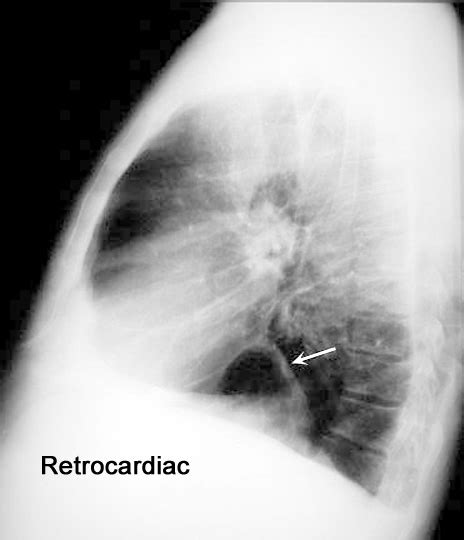 Retrocardiac Density