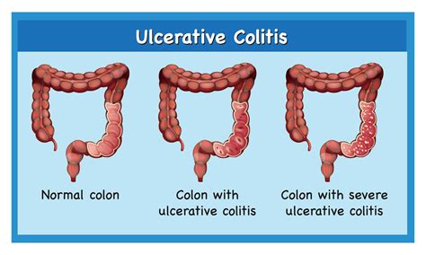 What Is Ulcertive Colitis। Causes Of Uc And Sign And Symptoms