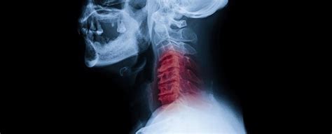 Another Example Of Opioids Having The Efficacy Of A Placebo Steven Fox Dds