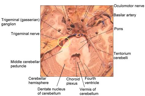 Trigeminal Ganglion Cadaver