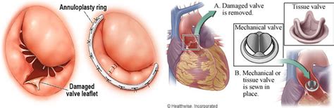 Heart Valve Replacement Surgery In India Cost Of Heart Valve