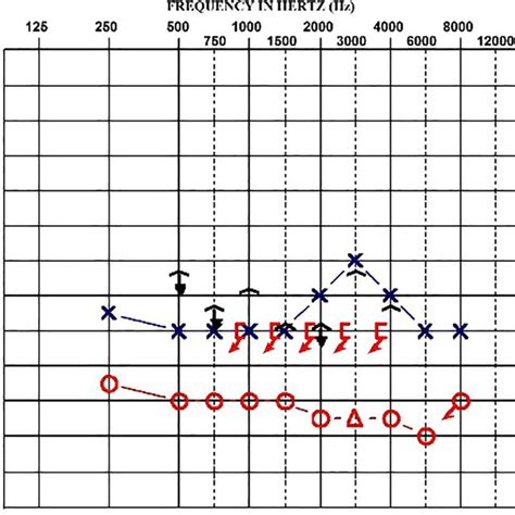 Baseline Audiogram For Participant 7 Download Scientific Diagram
