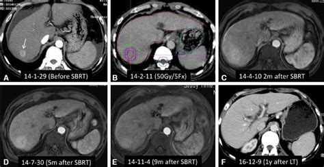 Sbrt As A Bridge To Liver Transplantation For Hcc In A 55 Year Old Man