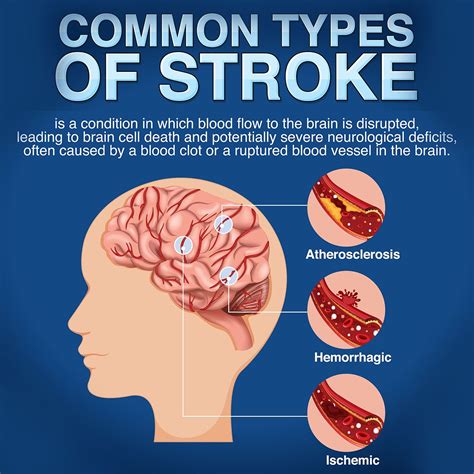 Understanding Stroke Causes Symptoms And Treatments
