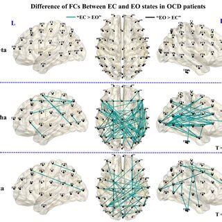 The Small World Parameters Of Whole Brain Functional Networks Of OCD
