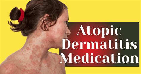 Atopic Dermatitis Medication
