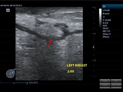 Atlas Of Breast Cancer Early Detection