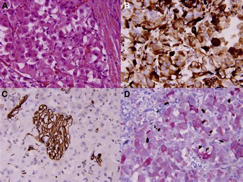 A Epithelioid Angiomyolipoma Composed Of Uniform Polygonal Or