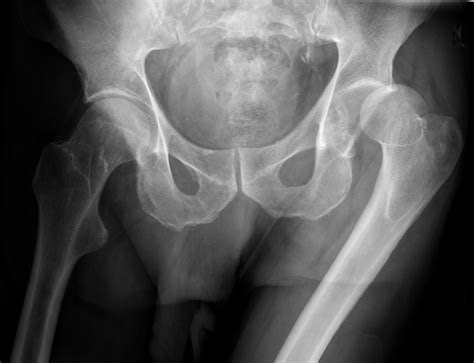 Hip Dislocation Buyxraysonline