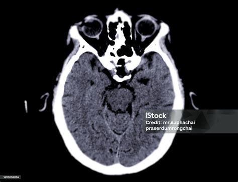 Ct Scan Of The Brain Axial Plane For Diagnosis Brain Tumor Stroke
