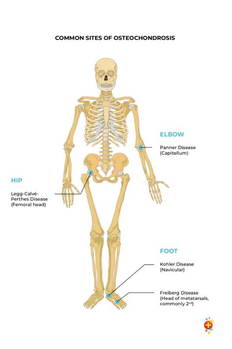 Osteochondrosis Dont Forget The Bubbles