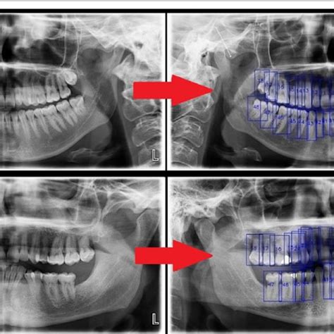 Detecting And Numbering The Teeth With The Deep Convolutional Neural Download Scientific