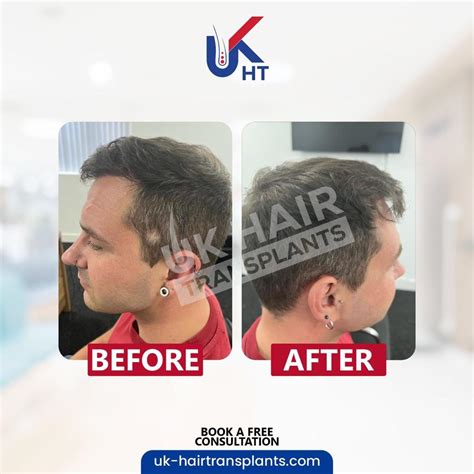 Fue Hair Transplant Uk Hair Transplants