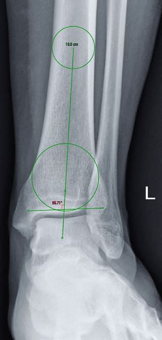 Distal Tibial Articular Angle Download Scientific Diagram Distal Tibial Articular Angle Download Scientific Diagram