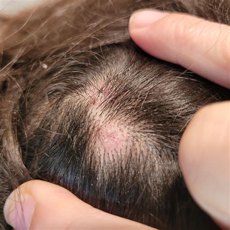 Itchy Scalp Rash Lesions R Dermatology